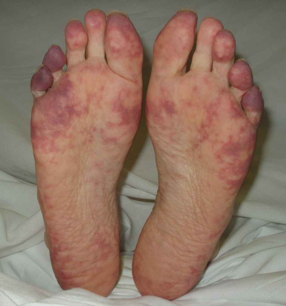 Purple Toe Syndrome – Clot Connect